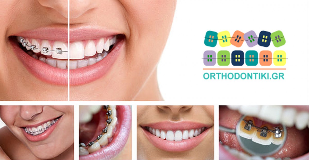 Ορθοδοντικά προβλήματα | Ορθοδοντική Νέο Ηράκλειο | Παλαιό Φάληρο | Νέα ...