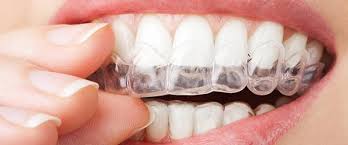 Essix | Ορθοδοντική Νέο Ηράκλειο | Παλαιό Φάληρο | Νέα Ερυθραία